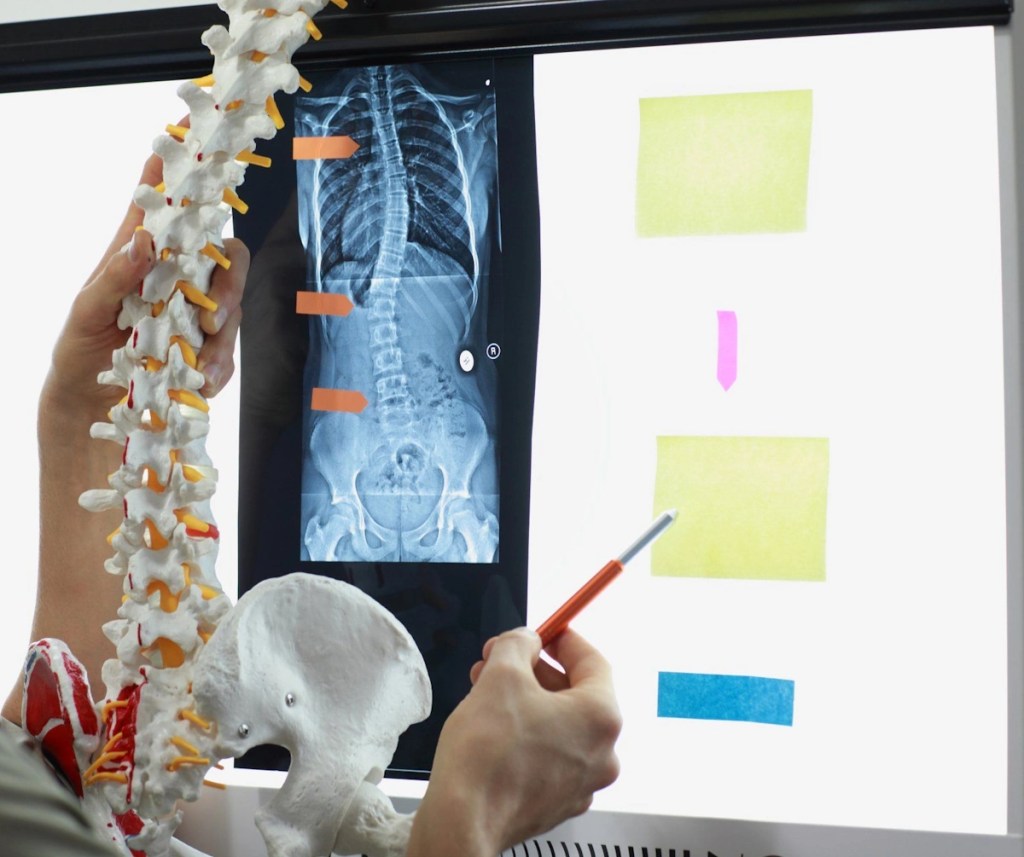 Fitting the Brace – Braced for Scoliosis